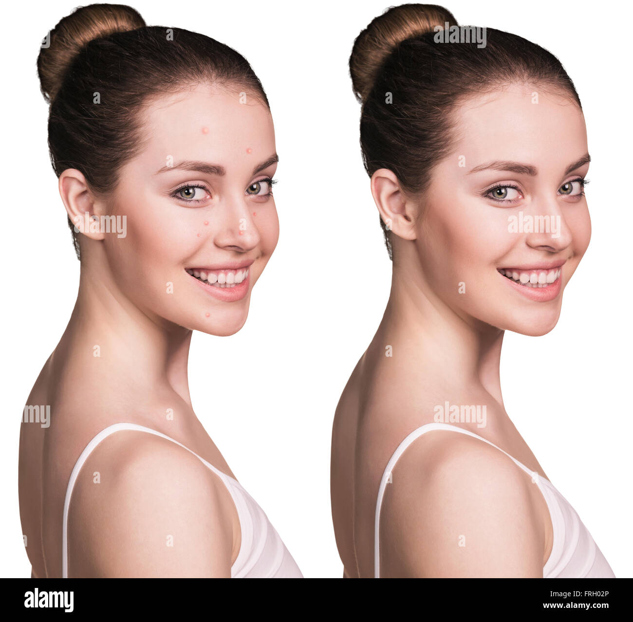 Woman before after pimple Cut Out Stock Images & Pictures - Alamy