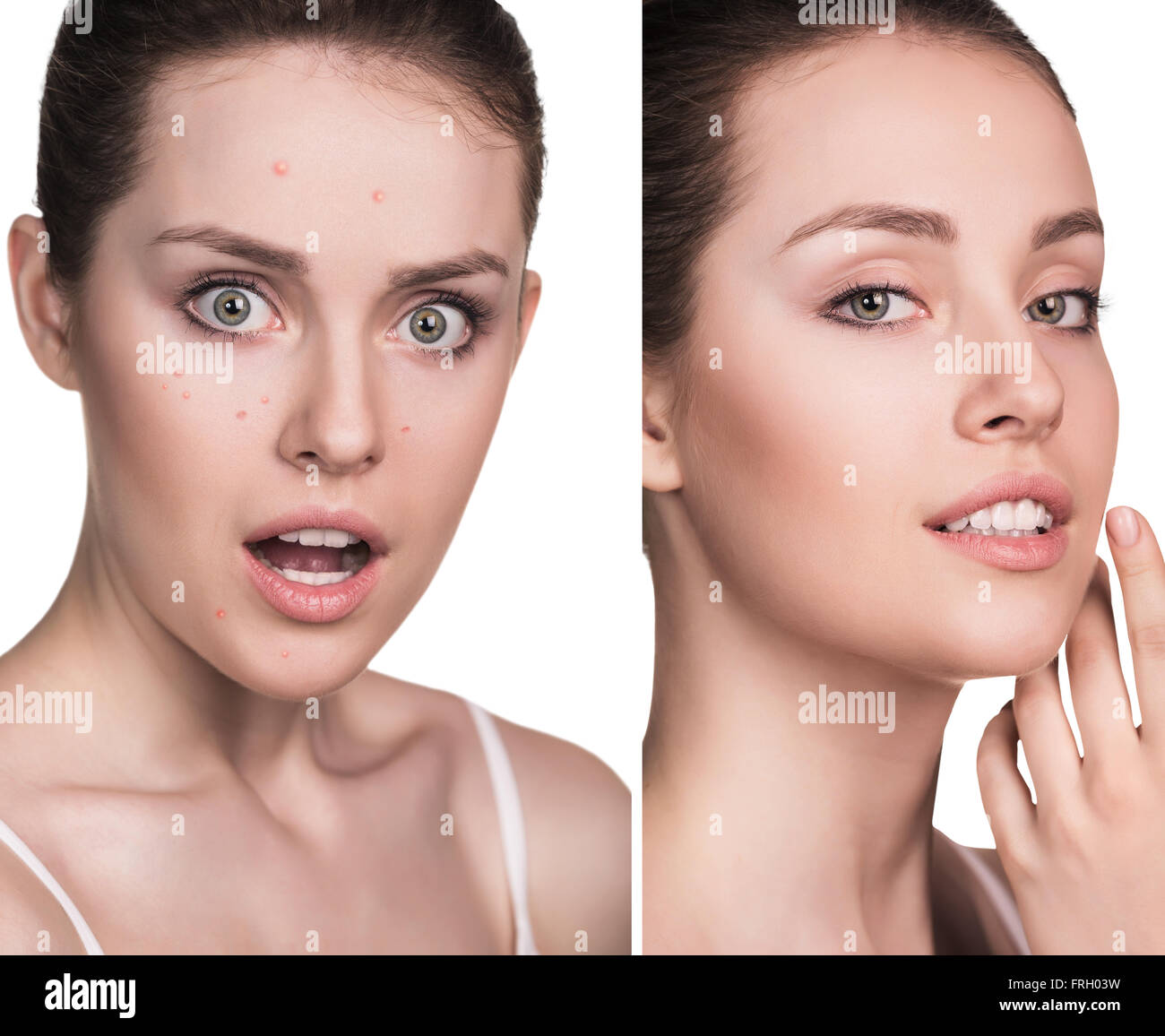 Woman with problem skin on her face Stock Photo - Alamy