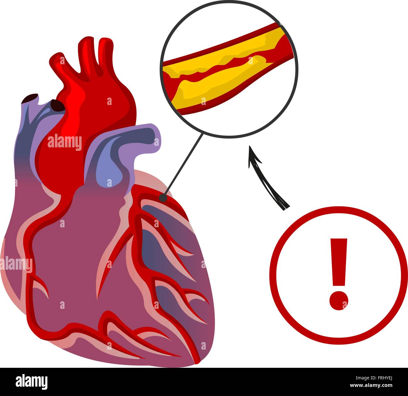 The risk of heart failure Stock Vector Image & Art - Alamy