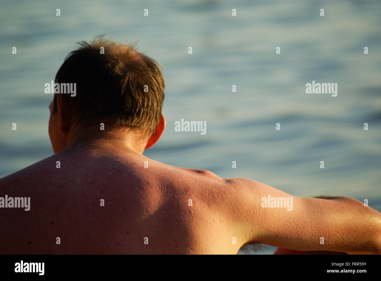 sunburned skin on a male during summer on beach Stock Photo - Alamy