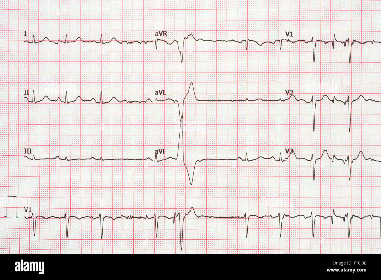 12 lead electrocardiogram hi-res stock photography and images - Alamy
