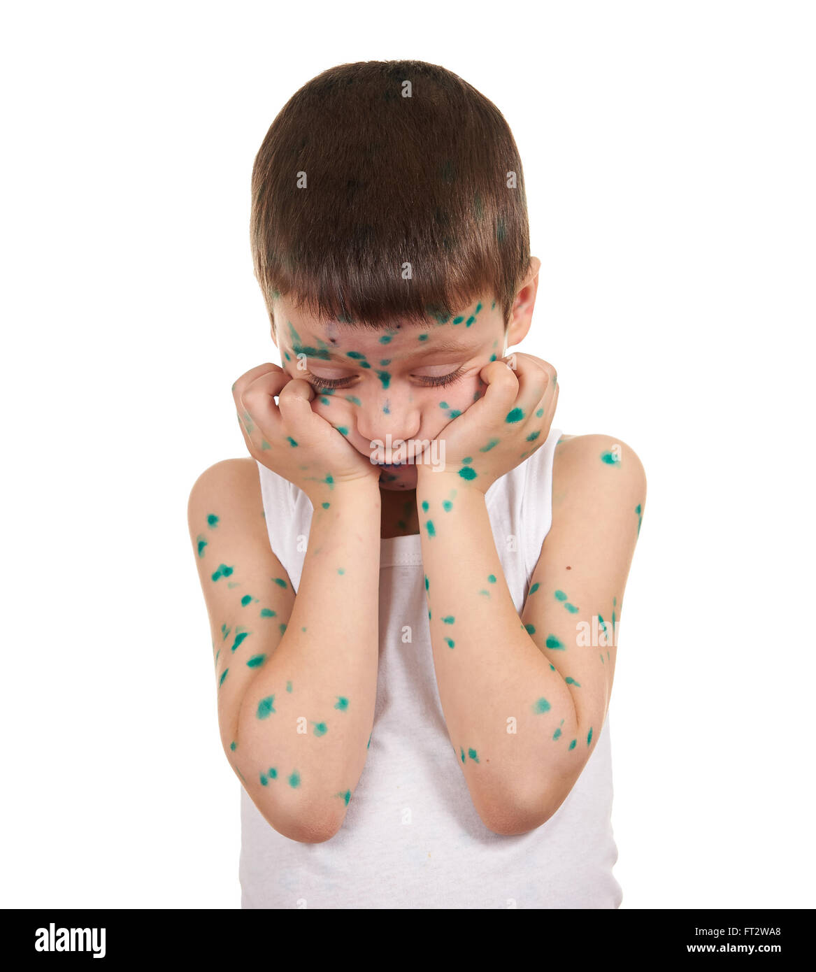 sick child has the virus on skin Stock Photo - Alamy