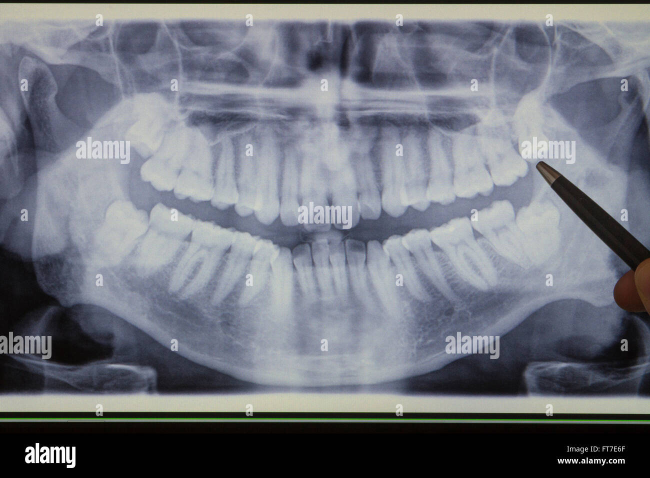 Pen indicating a wisdom tooth on a panoramic dental radiograph Stock ...