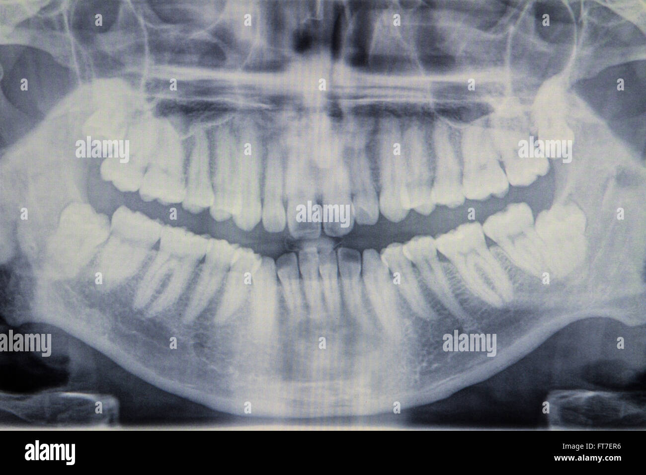 Panoramic Radiography Dental Definition at Cameron Kopsen blog