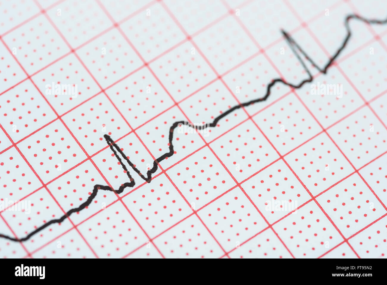 Sinus Heart Rhythm On Electrocardiogram Record Paper Showing Normal P ...
