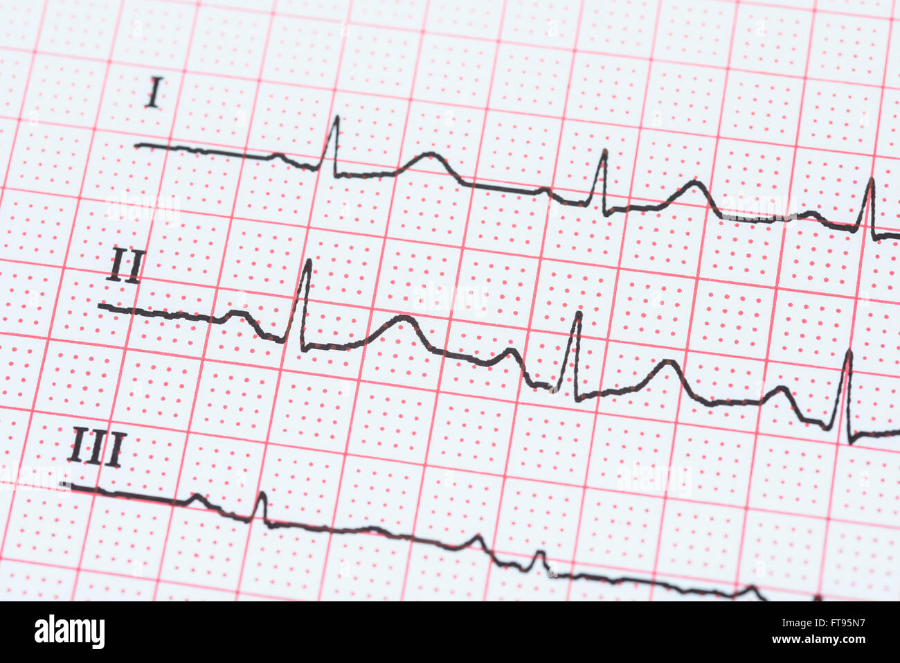 Sinus Heart Rhythm On Electrocardiogram Record Paper Showing Normal P ...