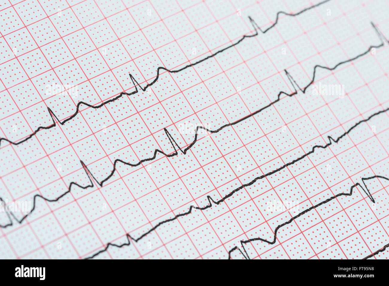 Sinus Heart Rhythm On Electrocardiogram Record Paper Showing Normal P ...