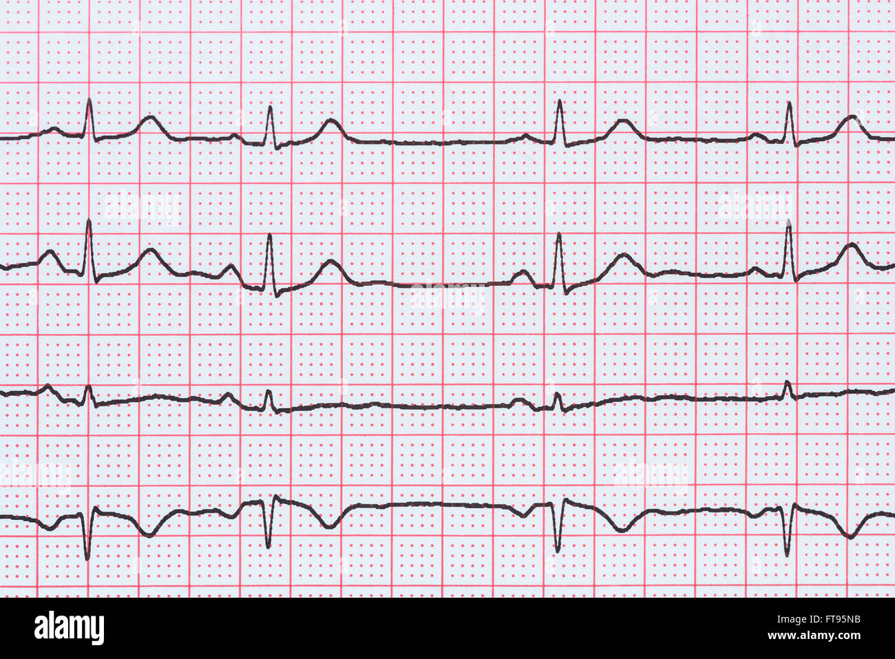 Sinus Heart Rhythm On Electrocardiogram Record Paper Showing Normal P ...