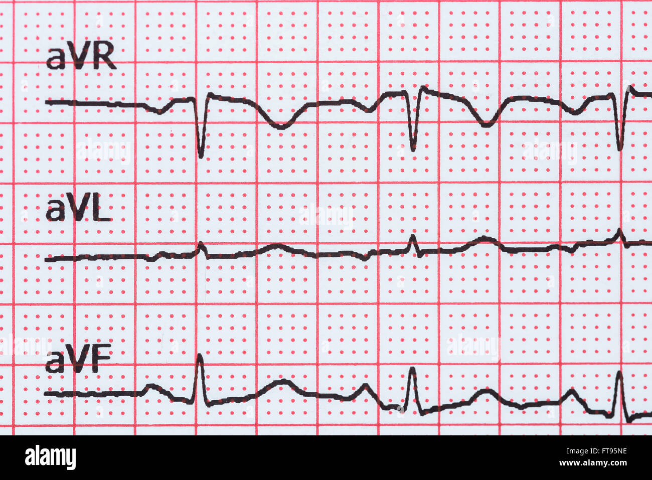 Sinus Heart Rhythm On Electrocardiogram Record Paper Showing Normal P ...