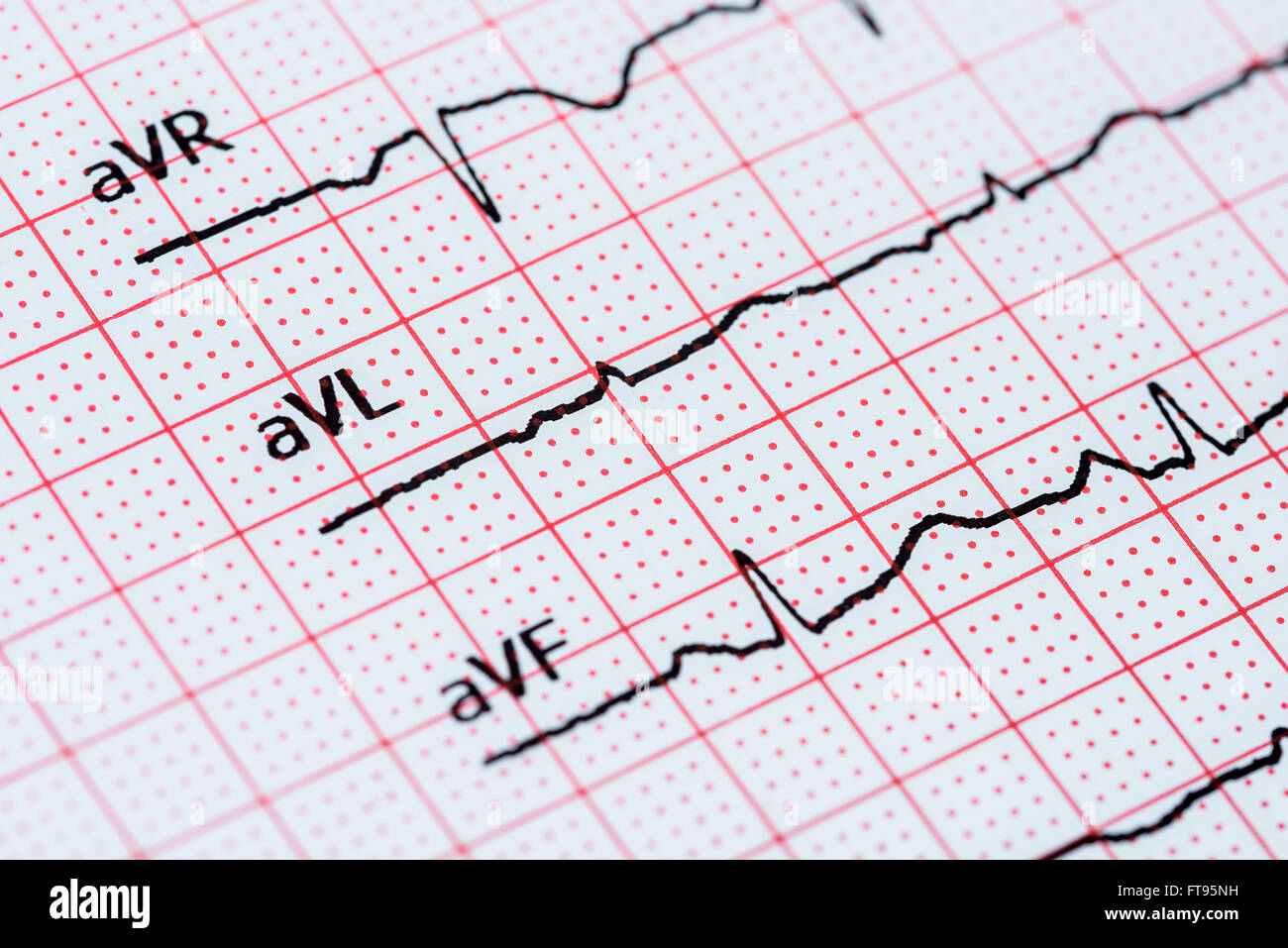 Sinus Heart Rhythm On Electrocardiogram Record Paper Showing Normal P ...