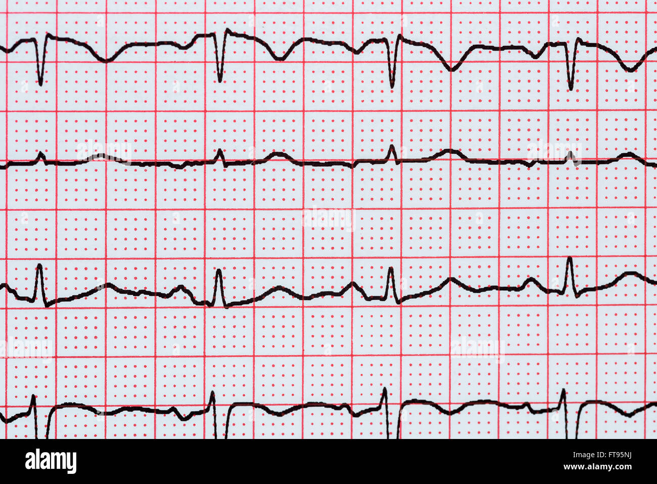 Normal ecg High Resolution Stock Photography and Images - Alamy