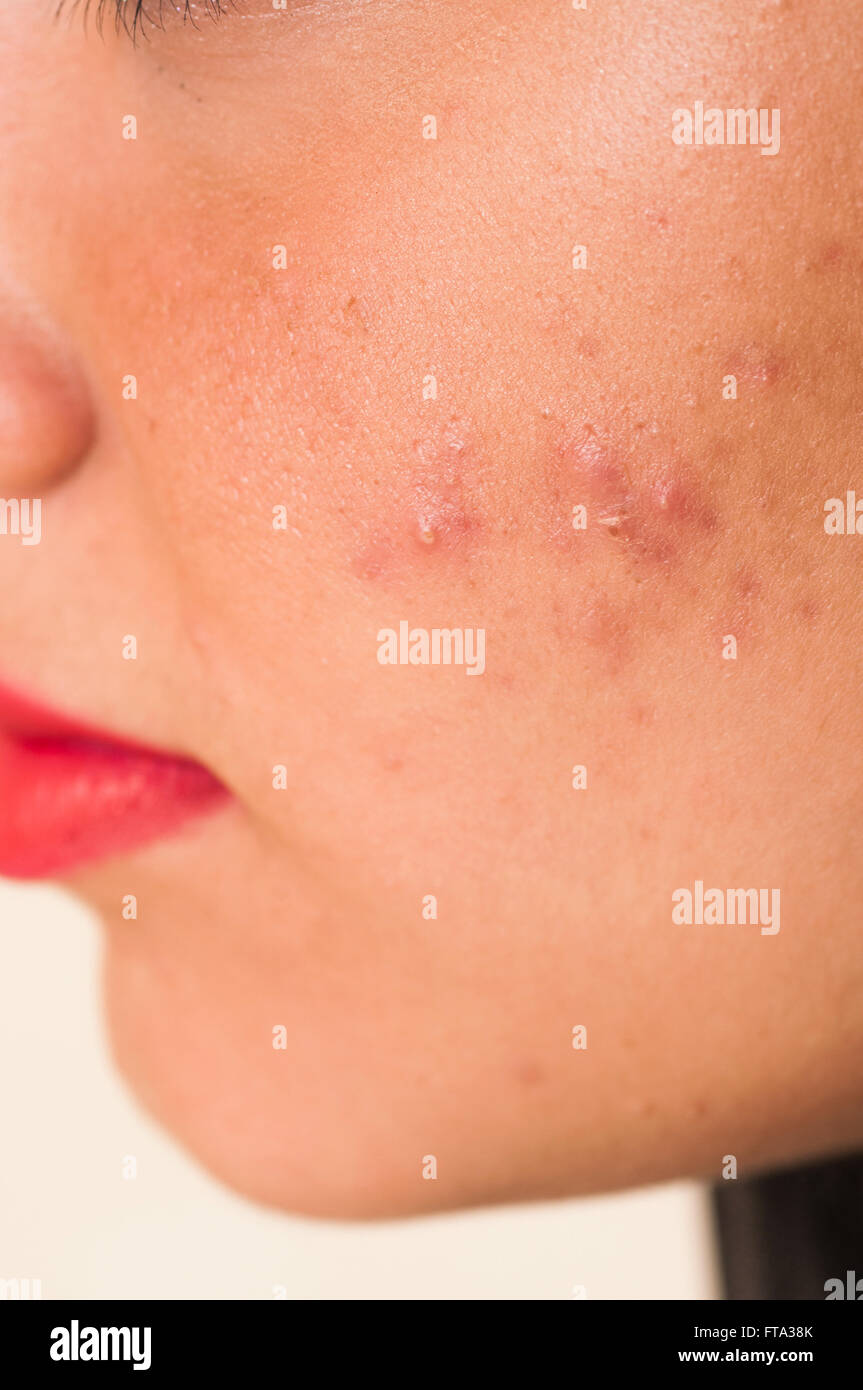 Acne hi-res stock photography and images - Alamy