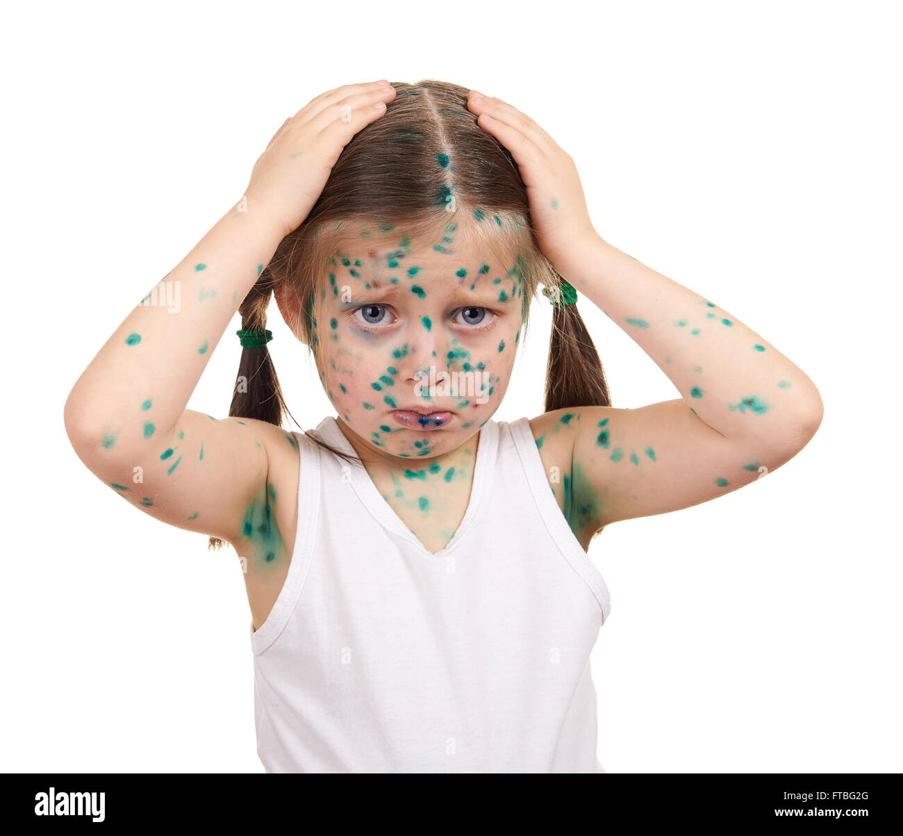 sick child has the virus on skin Stock Photo - Alamy
