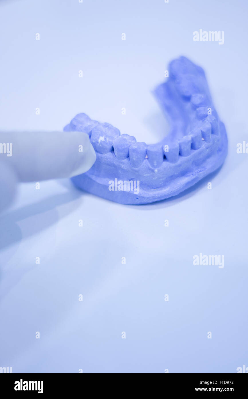 Dentists' dental teeth prosthetic mould in clinic Stock Photo - Alamy