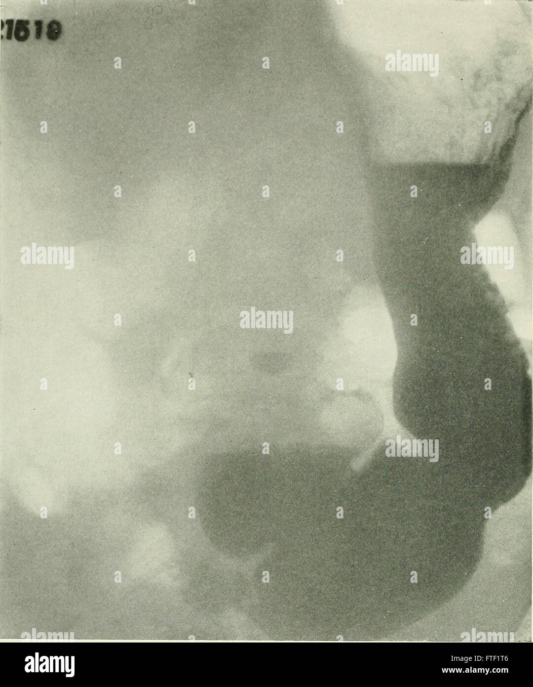 Cancer of the stomach; a clinical study of 921 operatively and ...