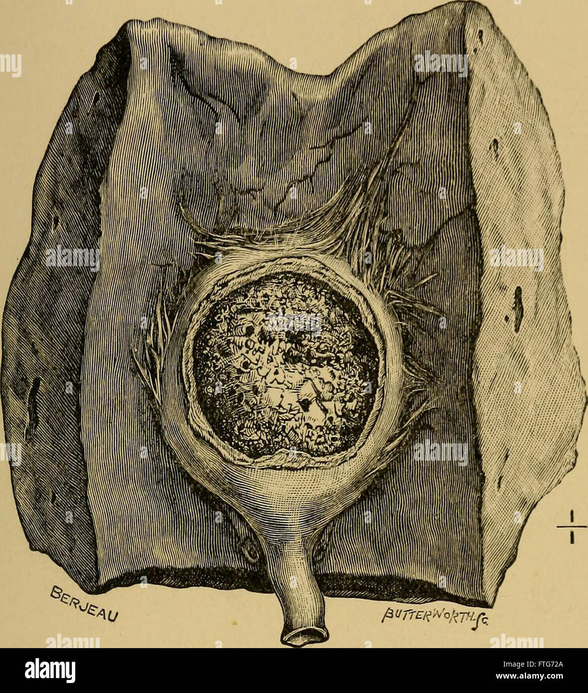 Gall stones hi-res stock photography and images - Alamy