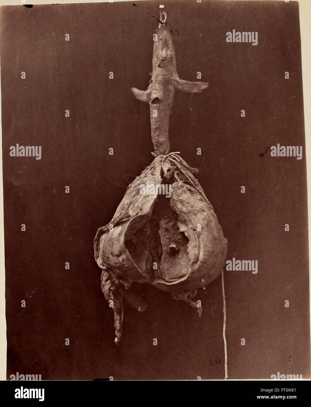 This 1865 collection presents photographs documenting surgical cases ...