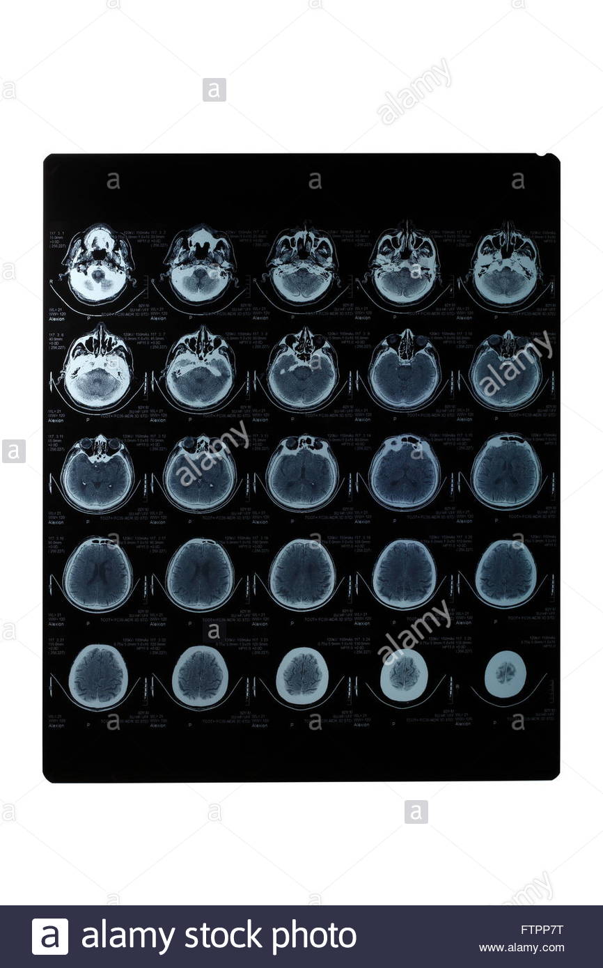 Brain X Ray Image Stock Photos & Brain X Ray Image Stock Images - Alamy