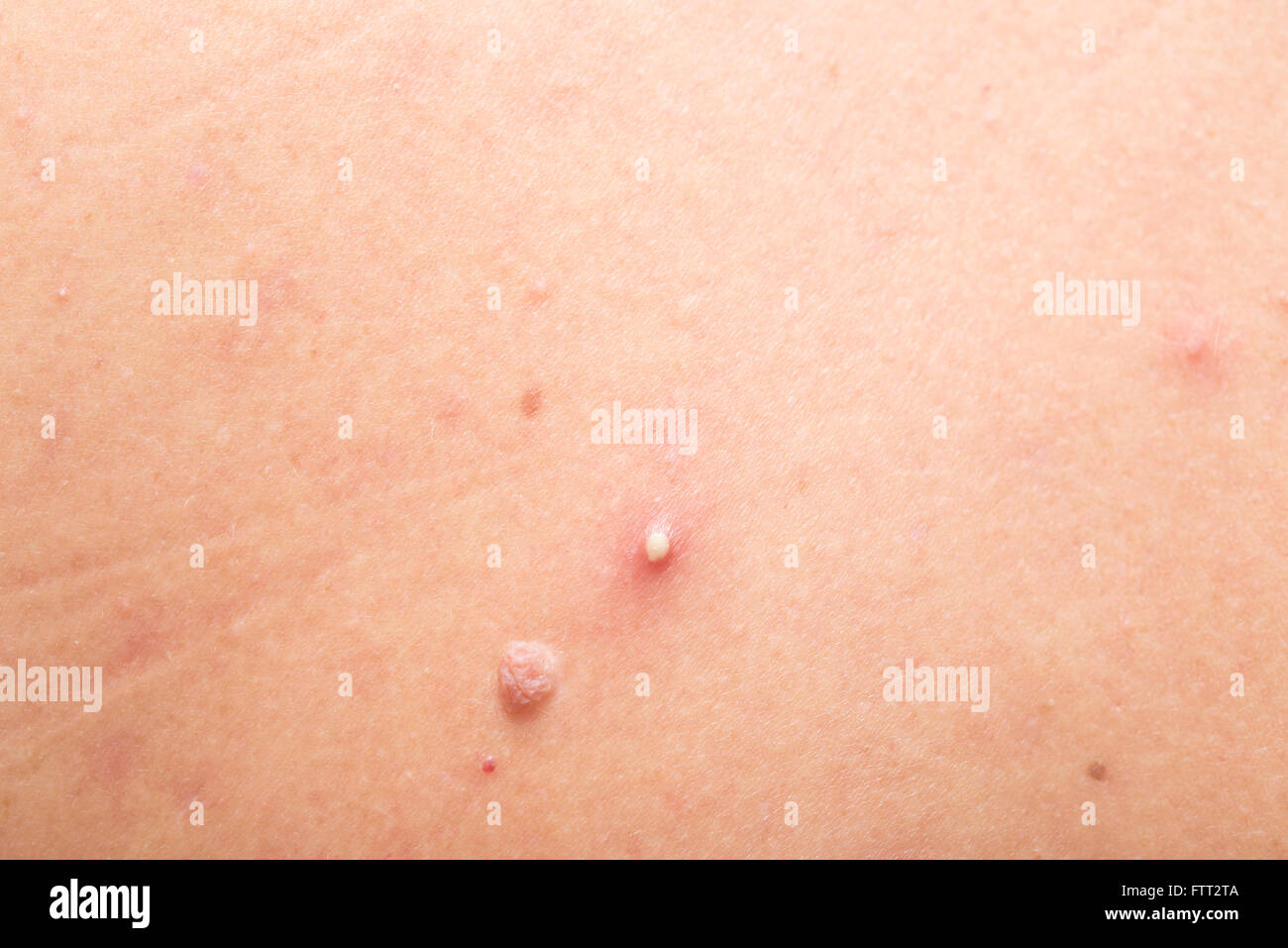 Close up shot blister hi-res stock photography and images - Alamy