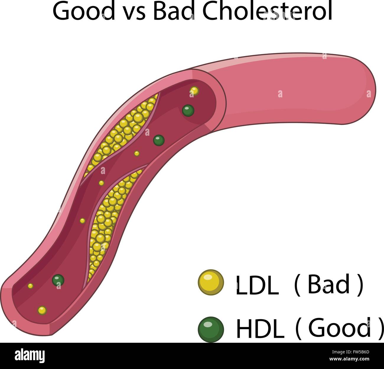 Illustration of an Artery blocked with bad cholesterol Stock Vector ...