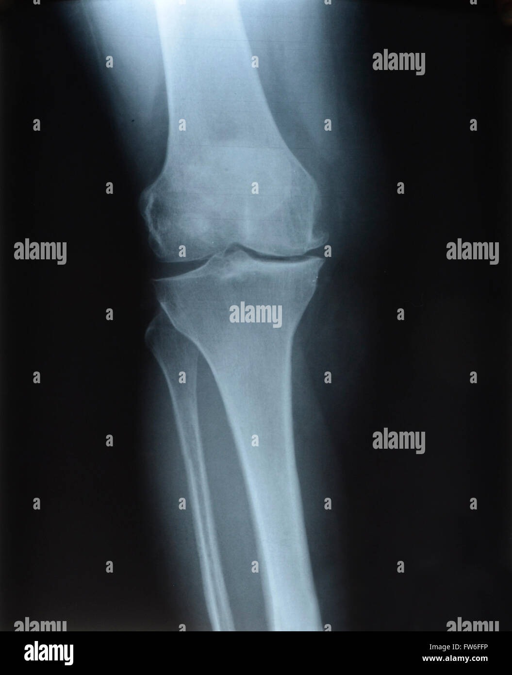 Knee Dislocation X Ray Dislocation Xray Knee Royalty Free Images,