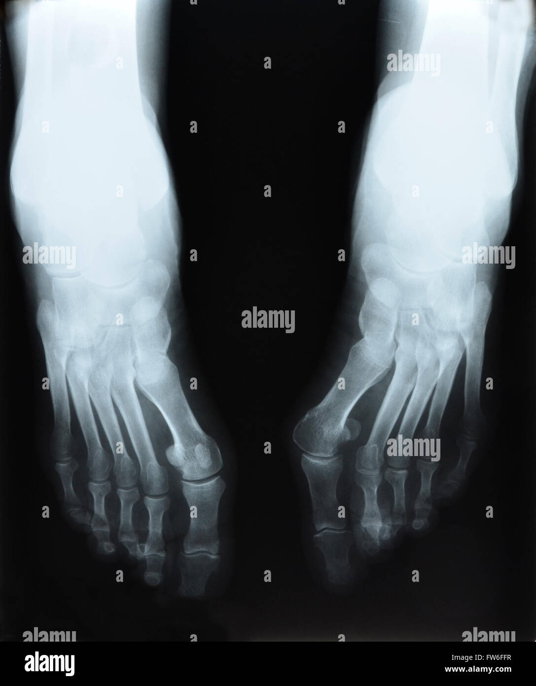Foot xray hi-res stock photography and images - Alamy