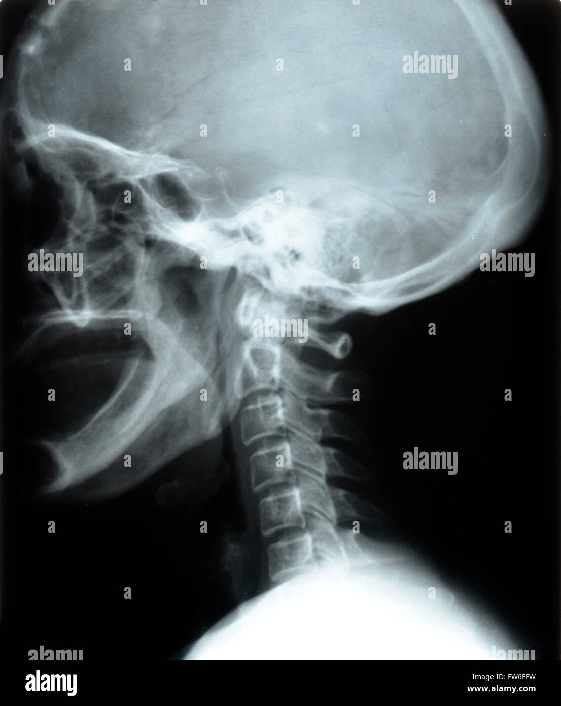 Head and neck x ray hi-res stock photography and images - Alamy
