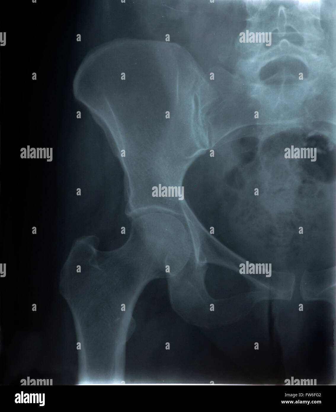 Pelvic exam hi-res stock photography and images - Alamy