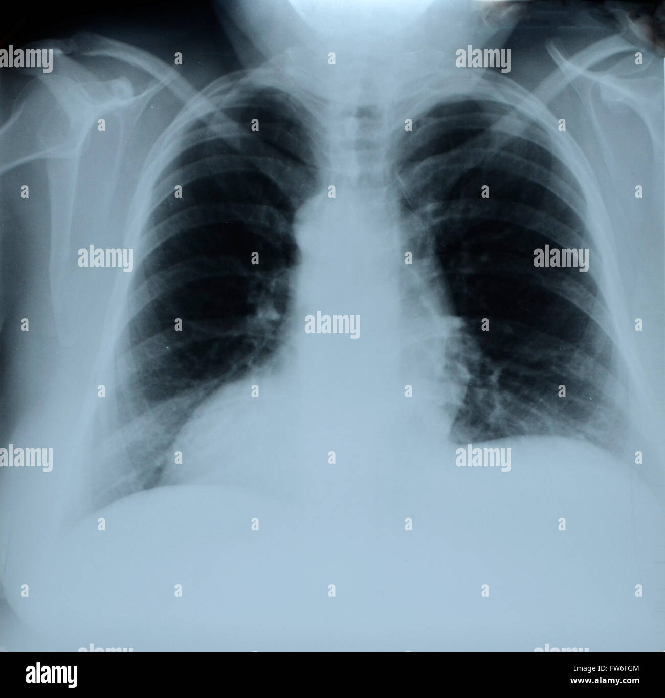 X ray image human chest hi-res stock photography and images - Alamy
