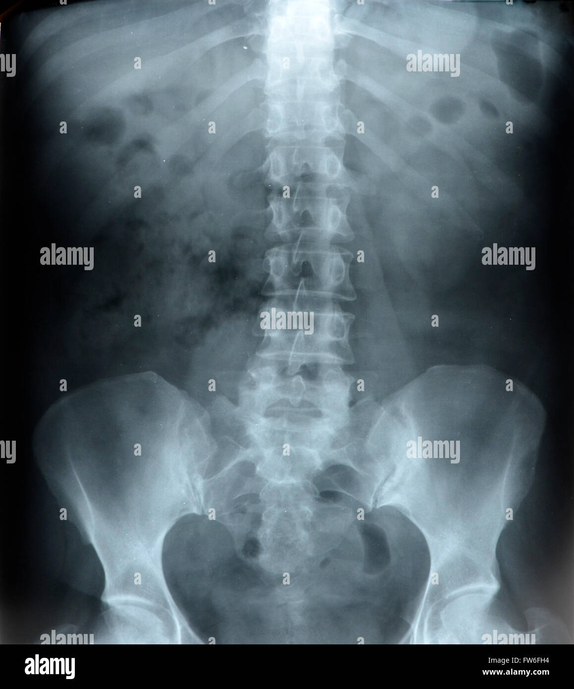 X ray pelvis hi-res stock photography and images - Alamy