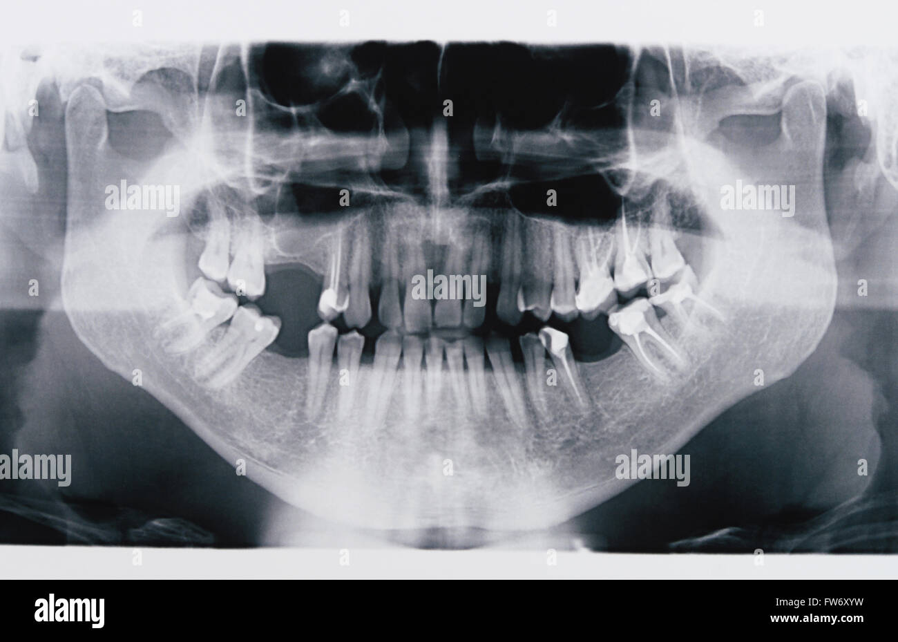 panoramic x-ray of human teeth before implanting Stock Photo - Alamy