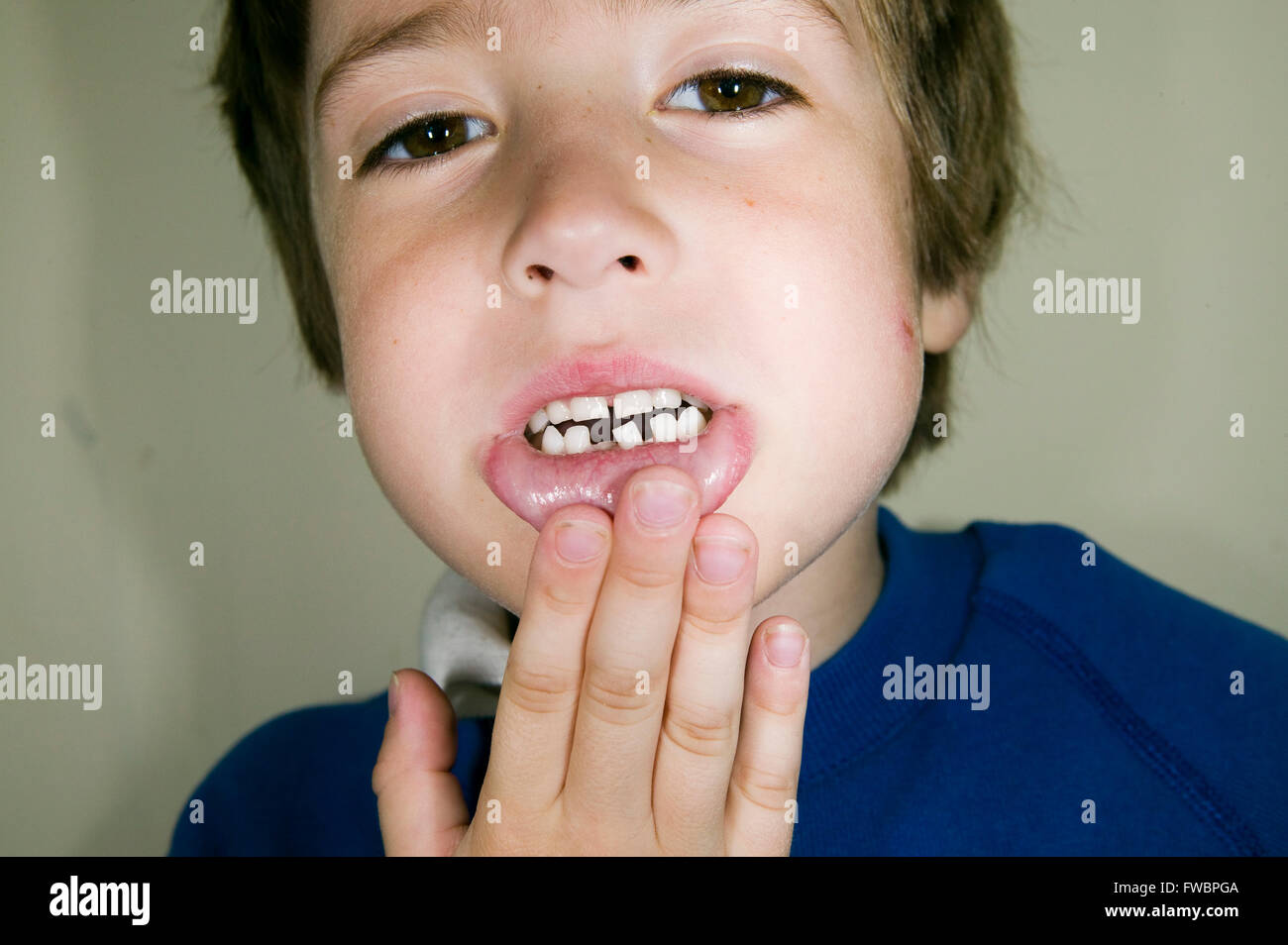 Fallen Out Fron Teeth Hi res Stock Photography And Images Alamy fallen-out-fron-teeth-hi-res-stock-photography-and-images-alamy