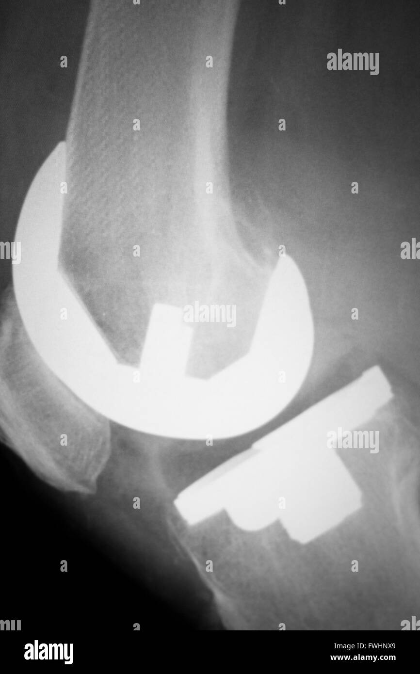 Knee and meniscus injury medical x-ray test scan result for adult ...