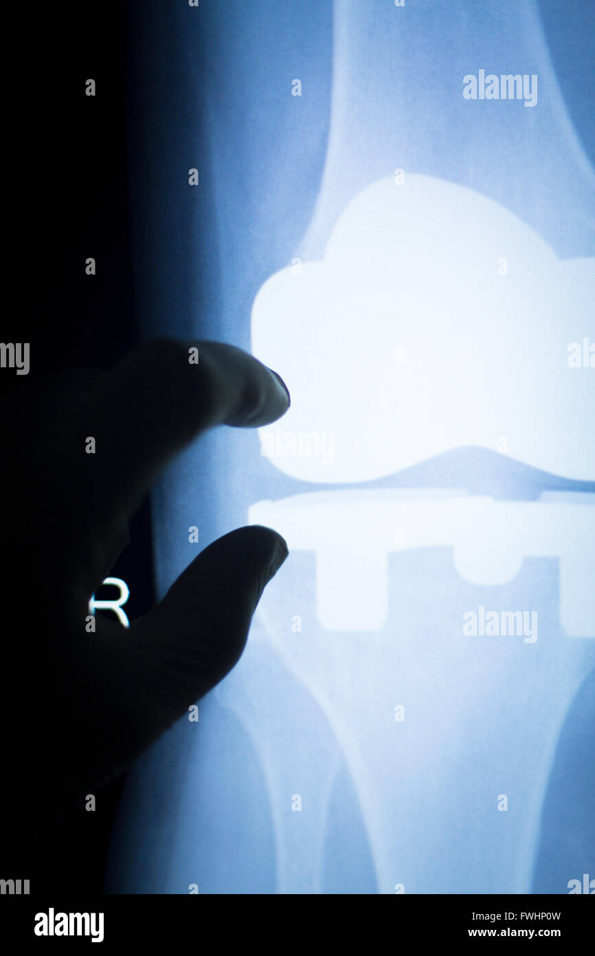 Knee and meniscus injury medical x-ray test scan result for adult ...
