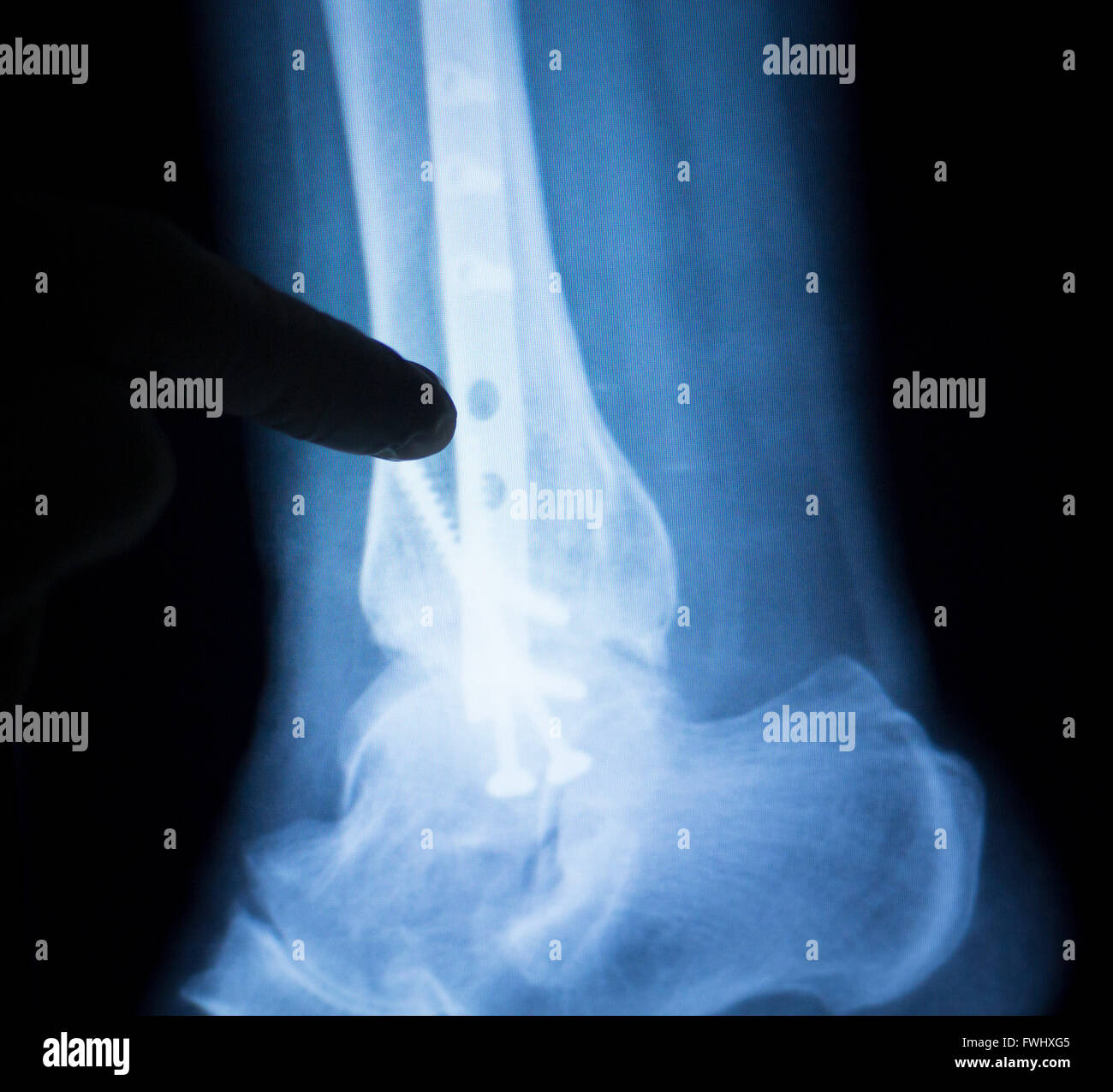 Ankle and leg injury medical x-ray test scan result for adult showing ...