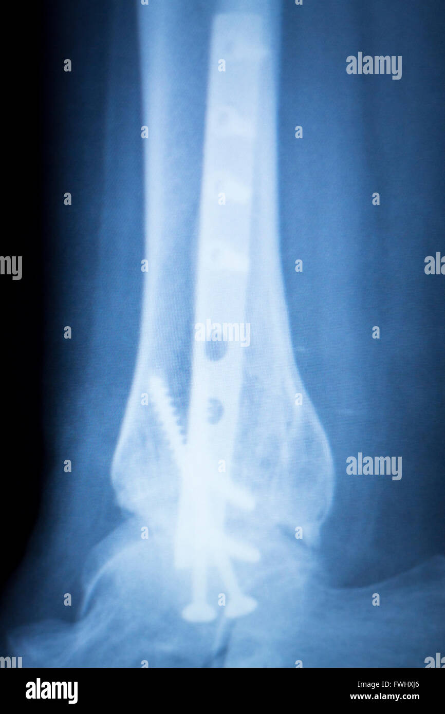 Ankle and leg injury medical x-ray test scan result for adult showing ...