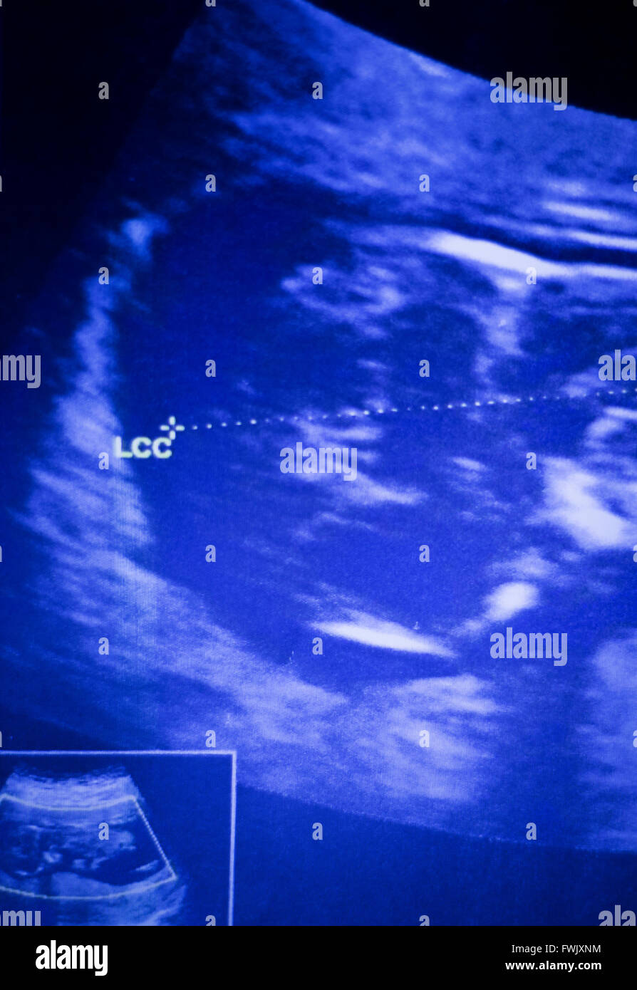 3 month fetus hi-res stock photography and images - Alamy