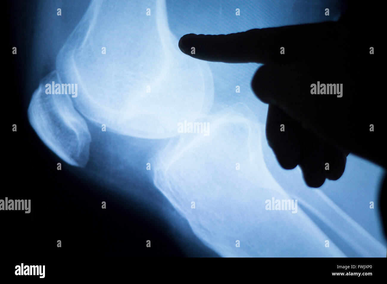 Knee and meniscus injury medical x-ray test scan result for adult ...