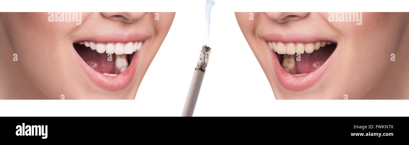 Smile before and after smoking. Concept of healthy smile Stock Photo ...