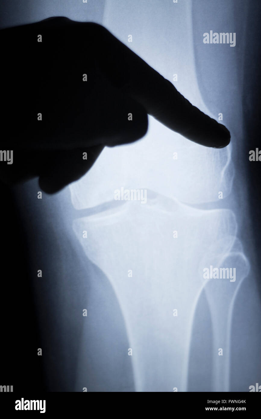 Knee and meniscus injury medical x-ray test scan result for adult ...