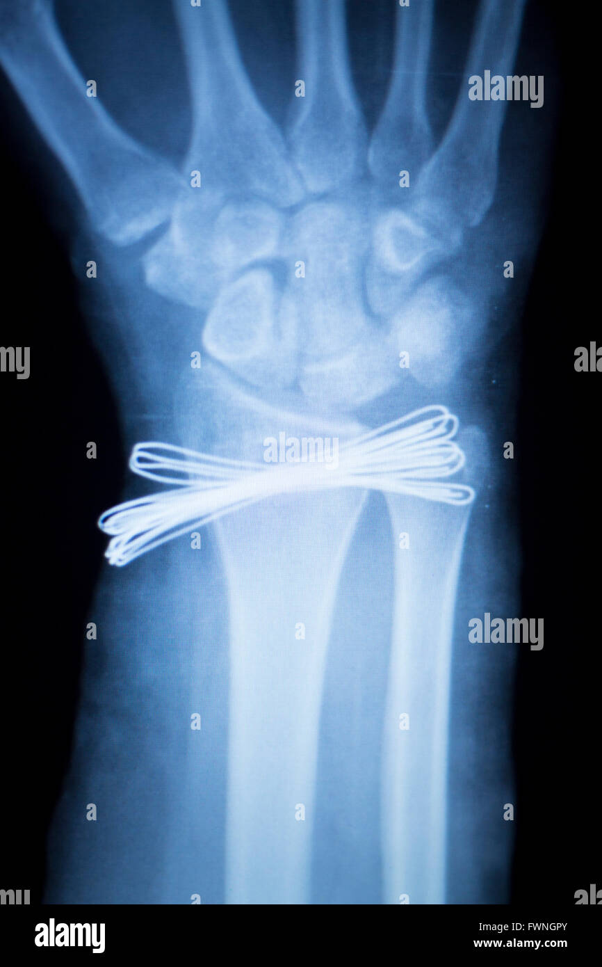 Wrist, hand, forearm and arm injury medical x-ray test scan result for ...