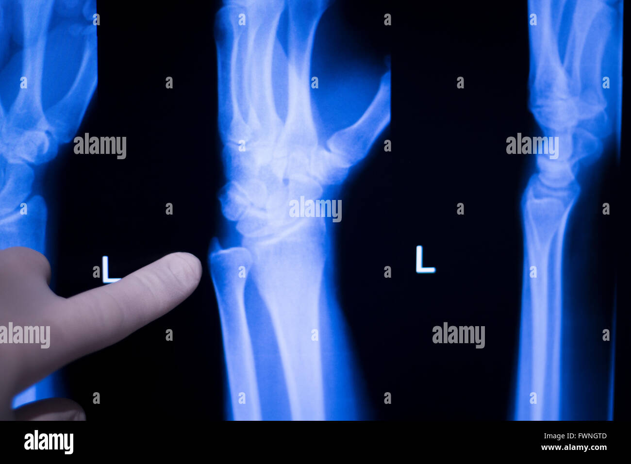 Wrist, hand, forearm and arm injury medical x-ray test scan result for ...