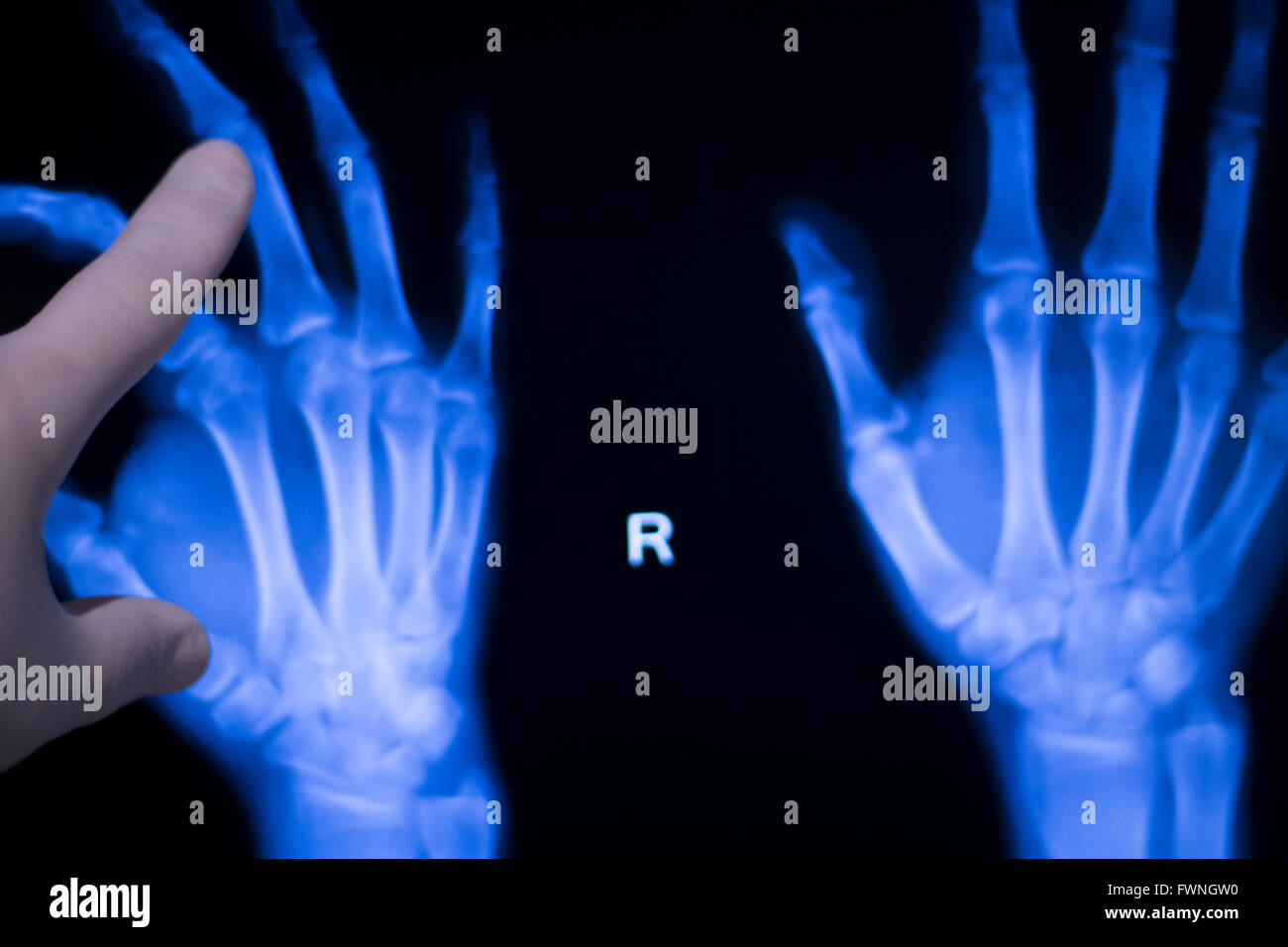 Wrist, hand, forearm and arm injury medical x-ray test scan result for ...