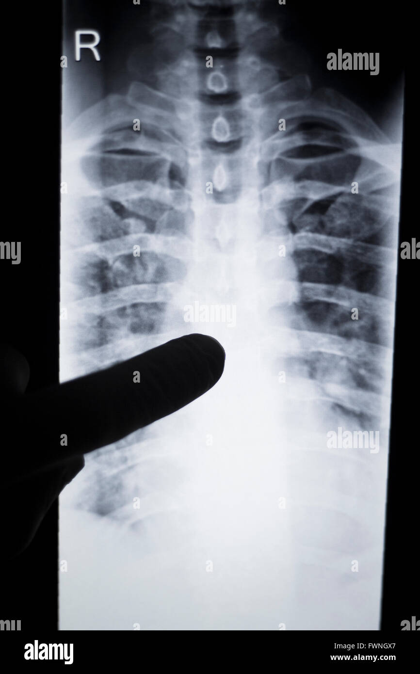 Spinal implant hi-res stock photography and images - Alamy