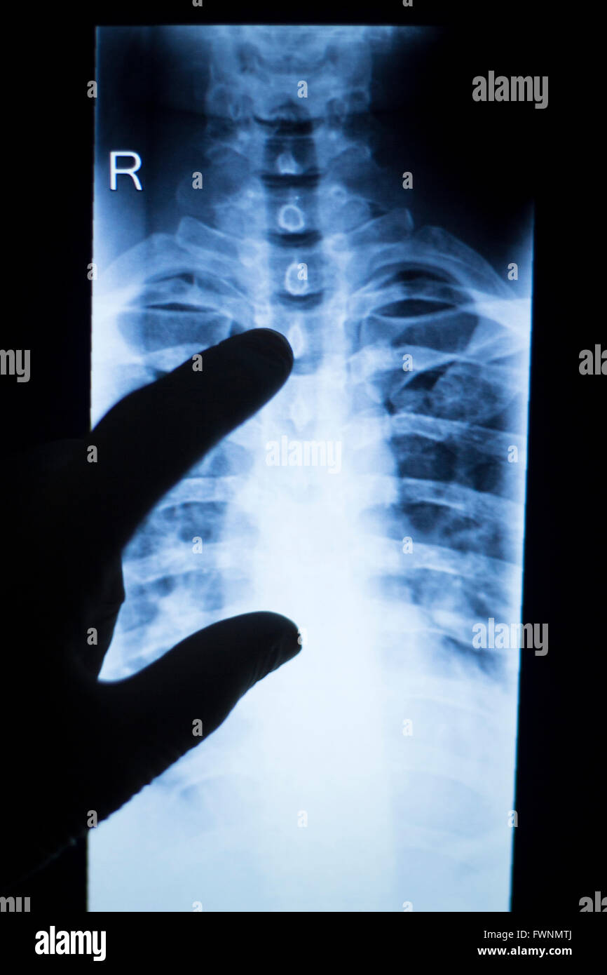 Spinal implant hi-res stock photography and images - Alamy