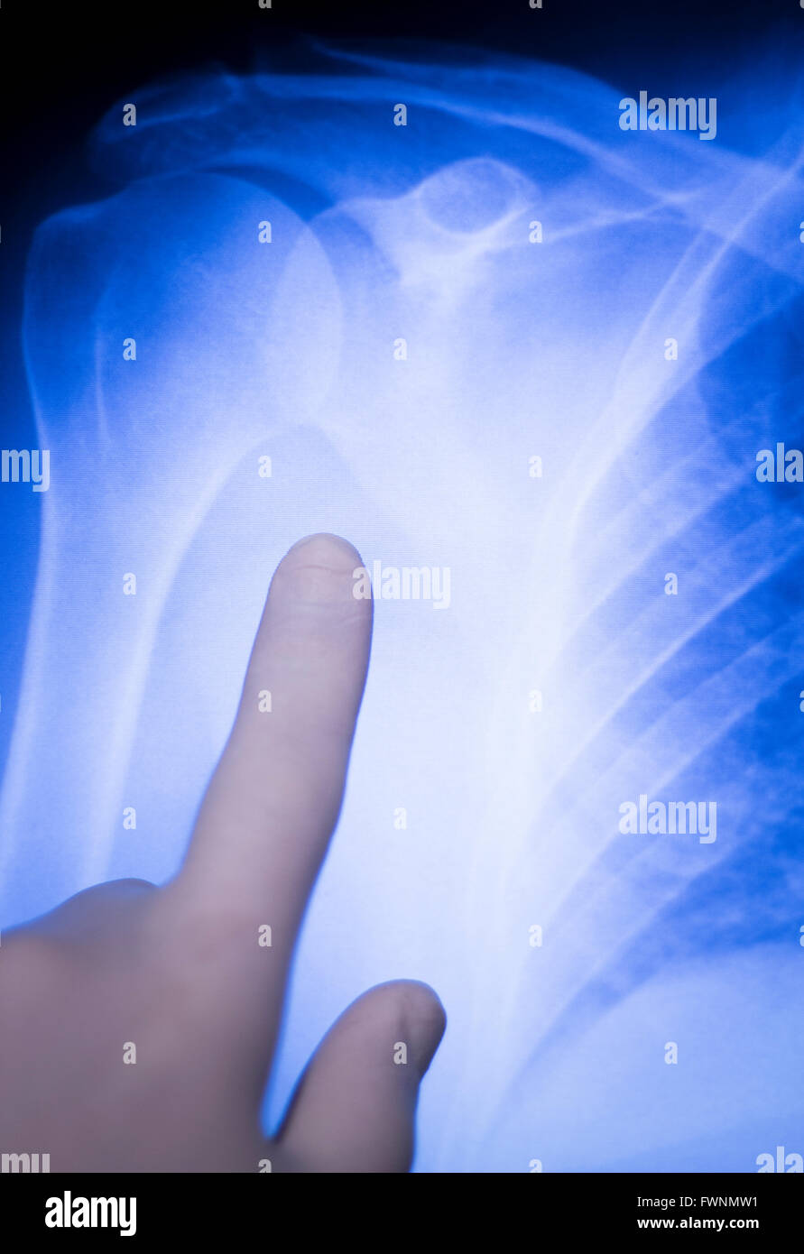 Shoulder joint medical x-ray test scan result for senior adult patient ...