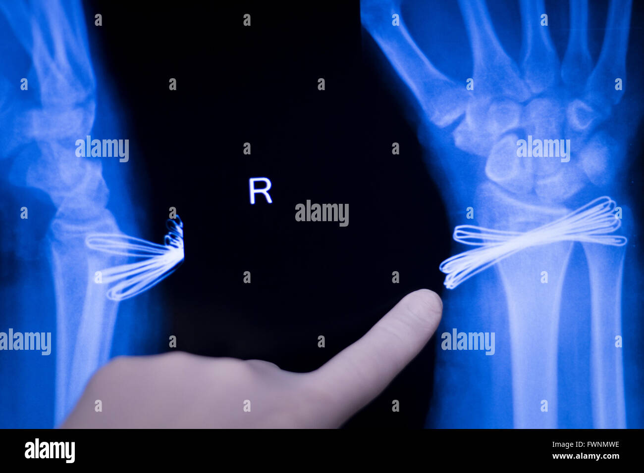 Wrist, hand, forearm and arm injury medical x-ray test scan result for ...