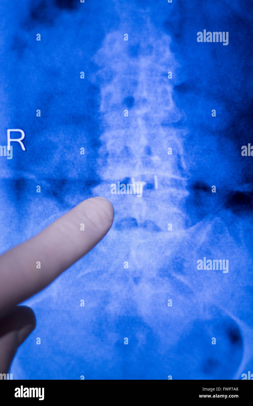Spinal implant hi-res stock photography and images - Alamy