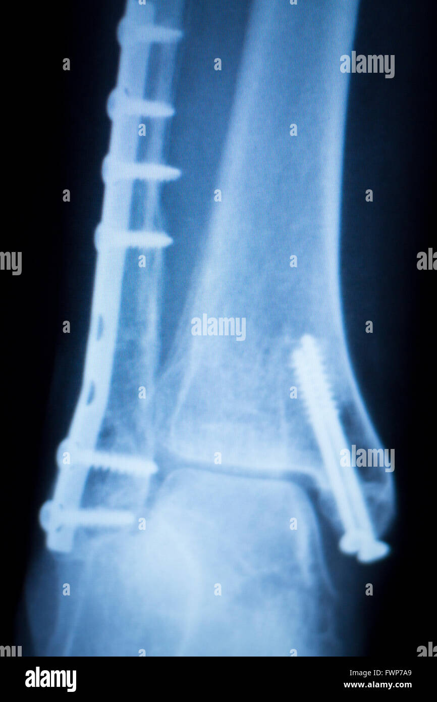 Ankle and leg injury medical x-ray test scan result for adult showing ...