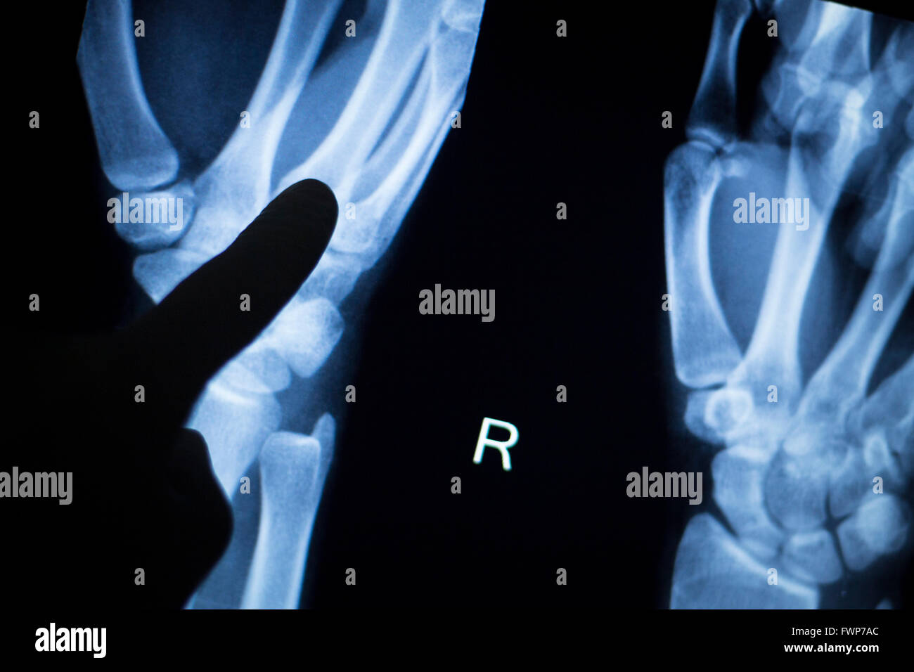 Wrist, hand, forearm and arm injury medical x-ray test scan result for ...
